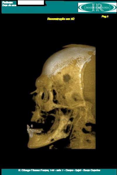 Mieloma Múltiplo :: NelmaRadiologia